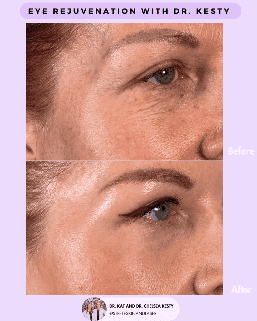 Before & After Results - St. Petersburg Skin & Laser Gallery